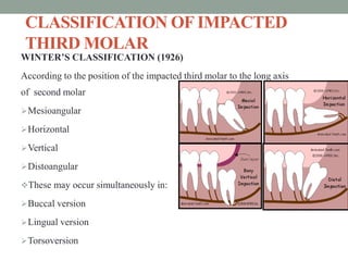 Impacted third molars | PPTX