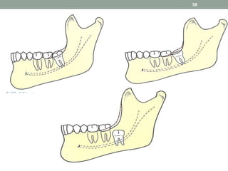 Impacted third molars | PPTX | Dental Health | Diseases and Conditions