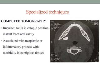 Impacted third molars | PPTX