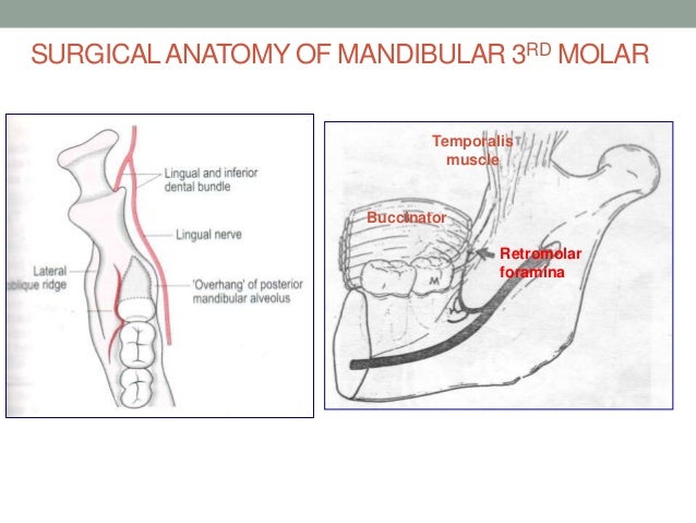 Impacted third molars