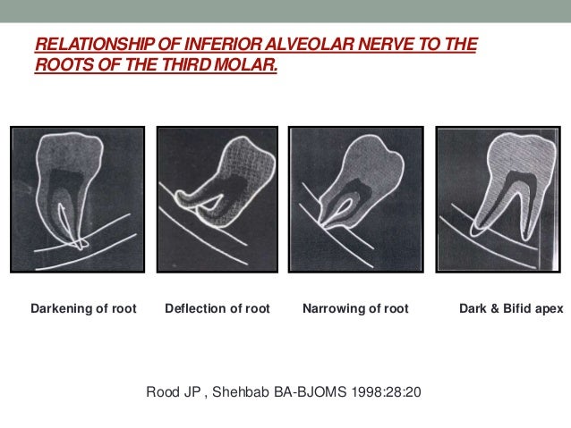 Impacted third molars