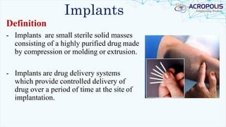 Implants | PDF