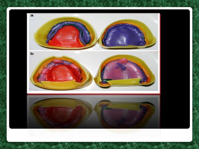 Final impression boxing and pouring | PPTX