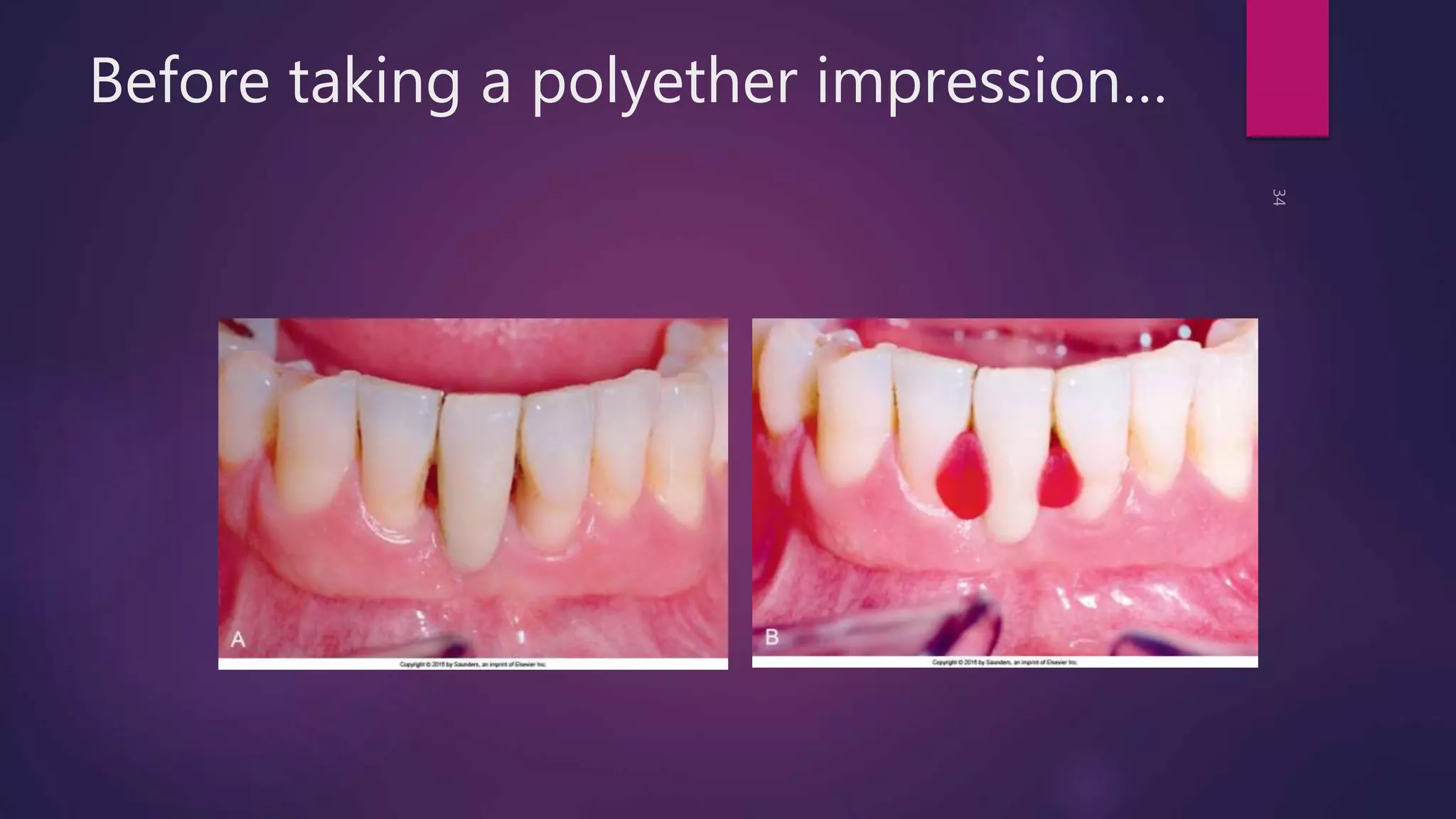 Final Impression Materials | PPTX | Oral care | Personal Care