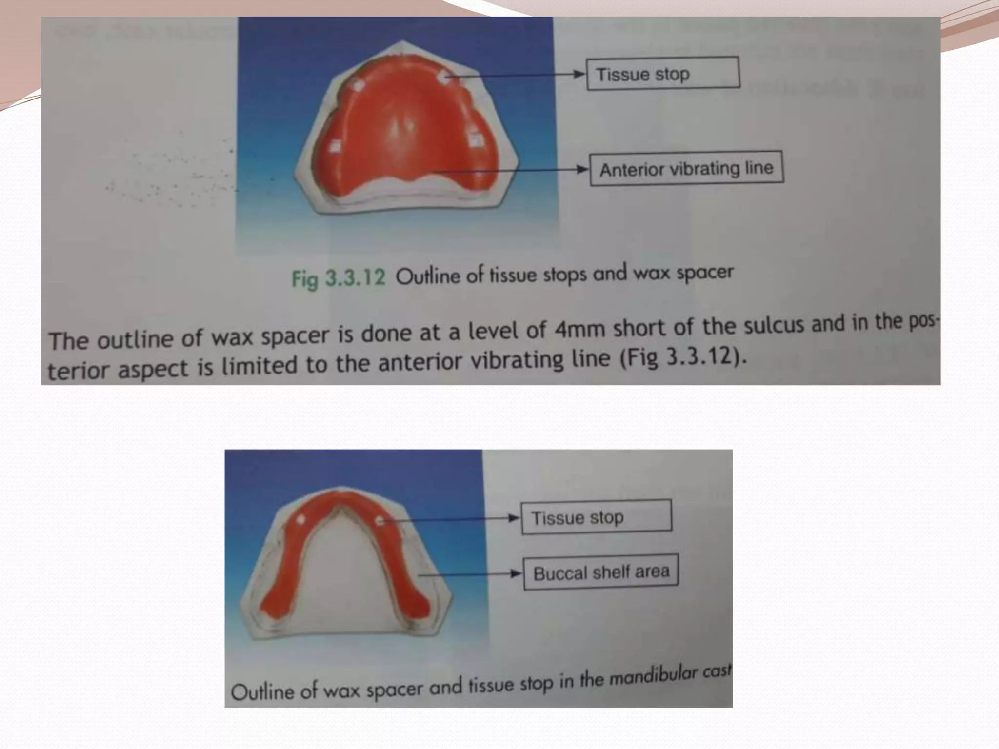 Secondary impression in complete denture CD | PPTX