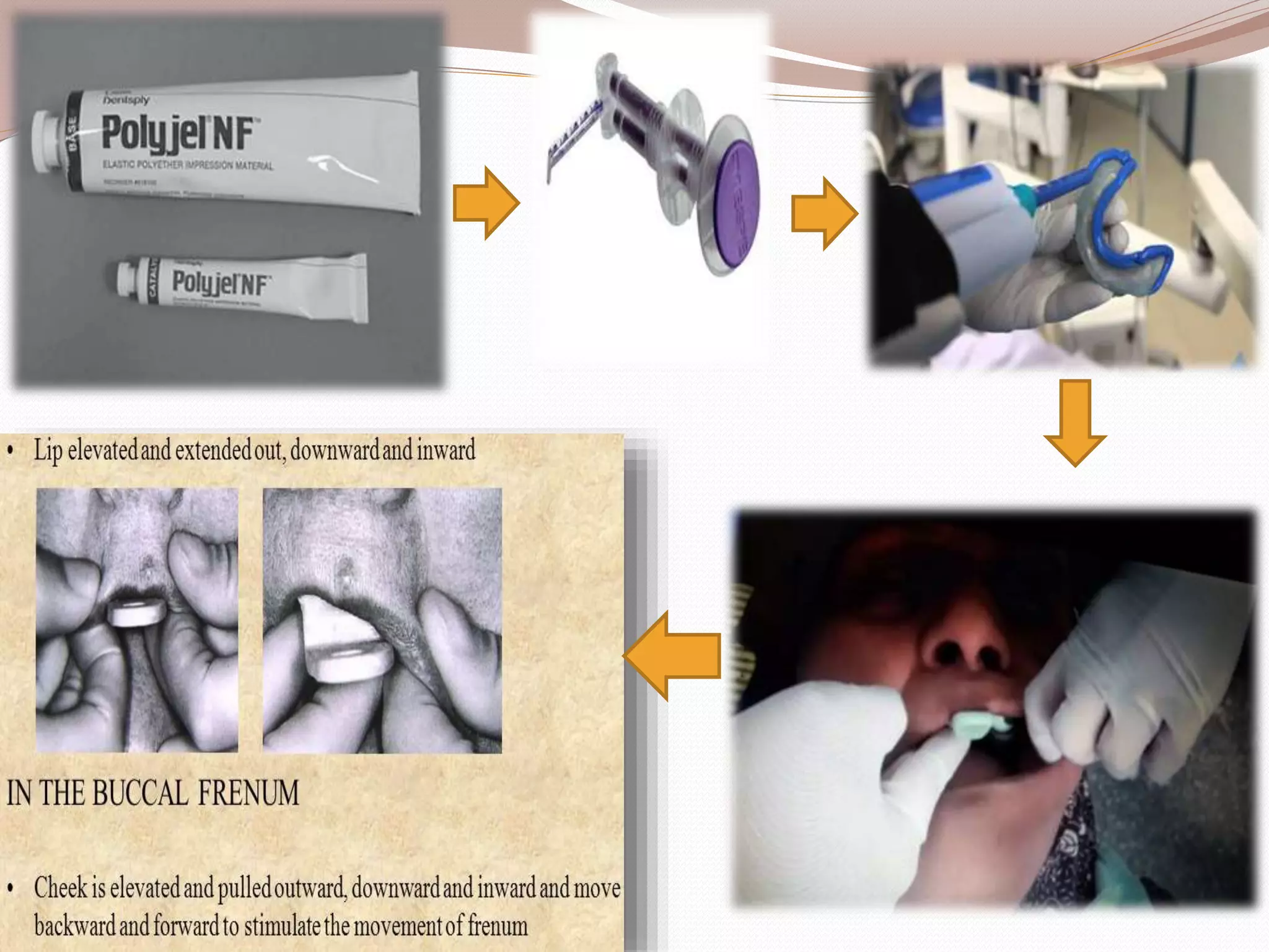 Secondary impression in complete denture CD | PPTX