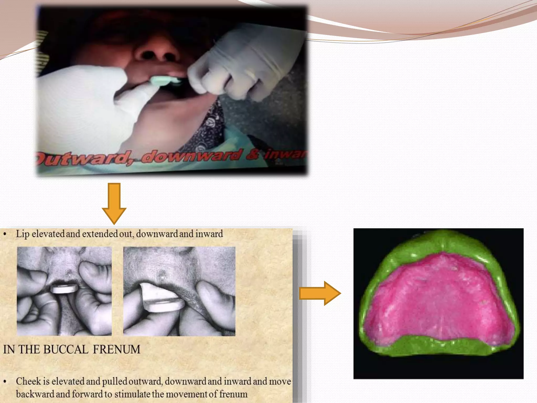 Secondary impression in complete denture CD | PPTX