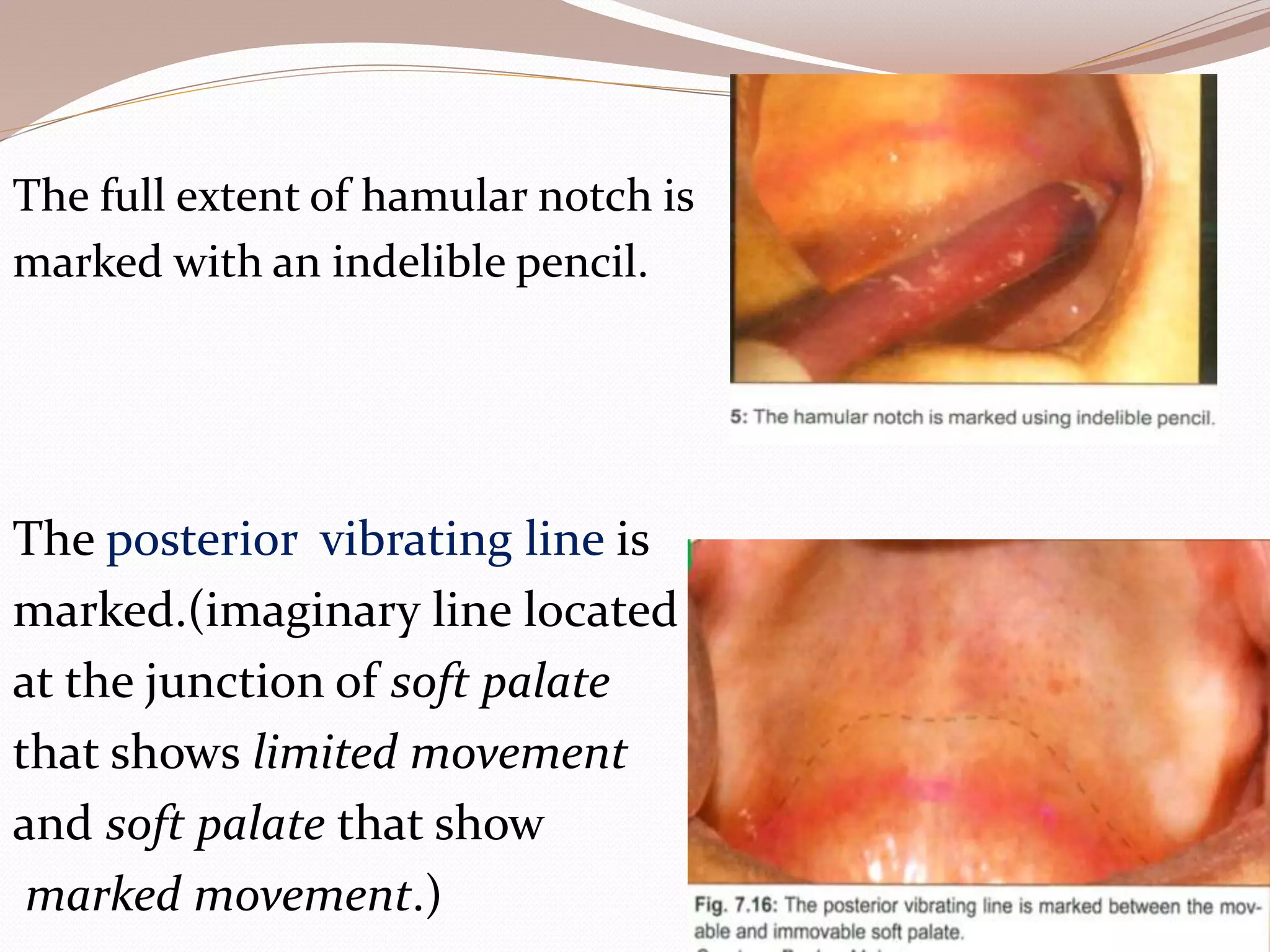 Secondary impression in complete denture CD | PPTX