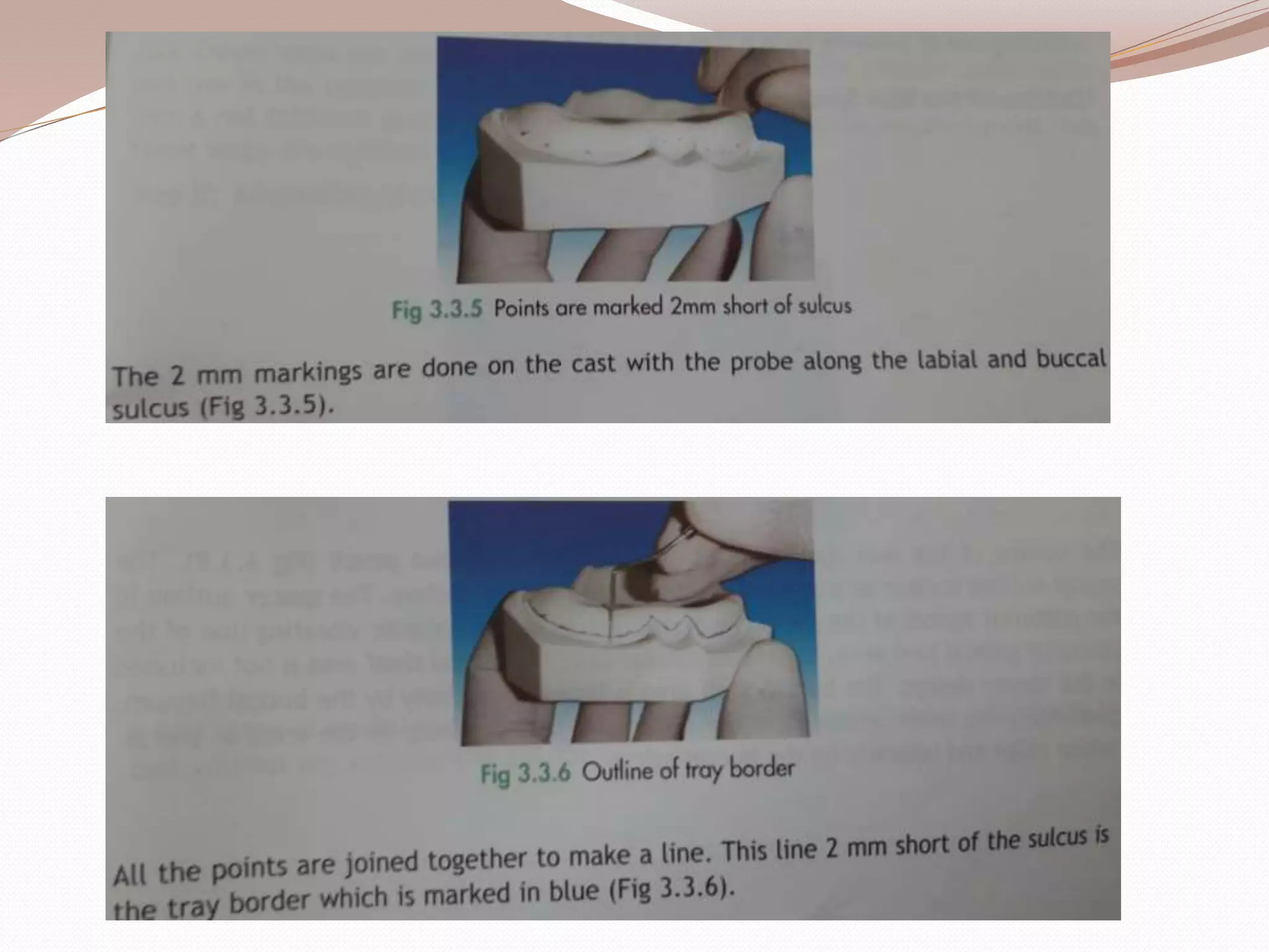 Secondary impression in complete denture CD | PPTX