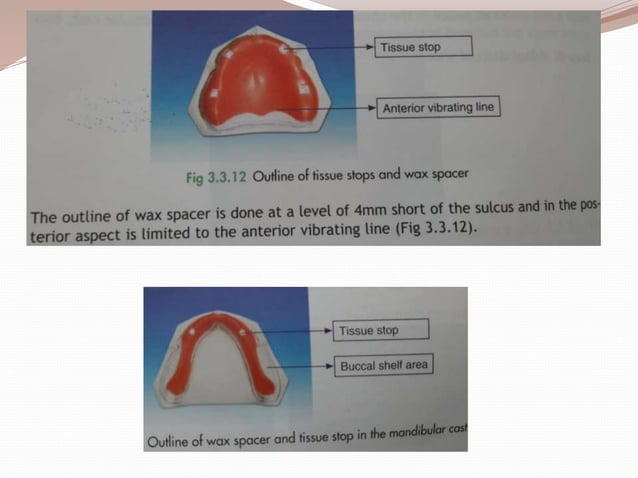 Secondary impression in complete denture CD | PPTX | Oral care ...