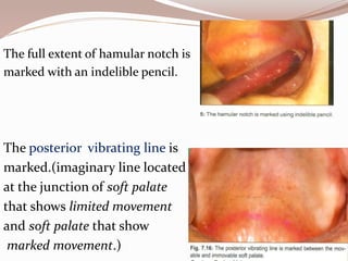 Secondary impression in complete denture CD | PPTX