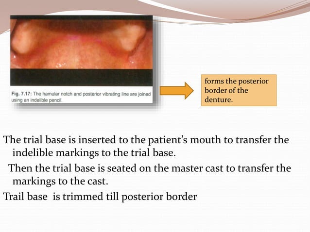 Secondary impression in complete denture CD | PPTX | Oral care ...
