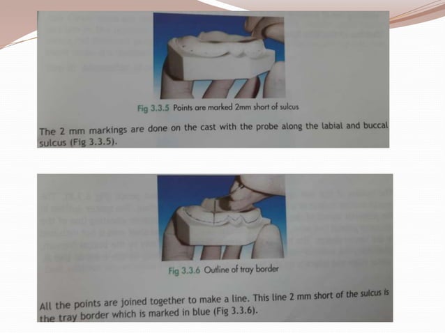 Secondary impression in complete denture CD | PPTX | Oral care ...