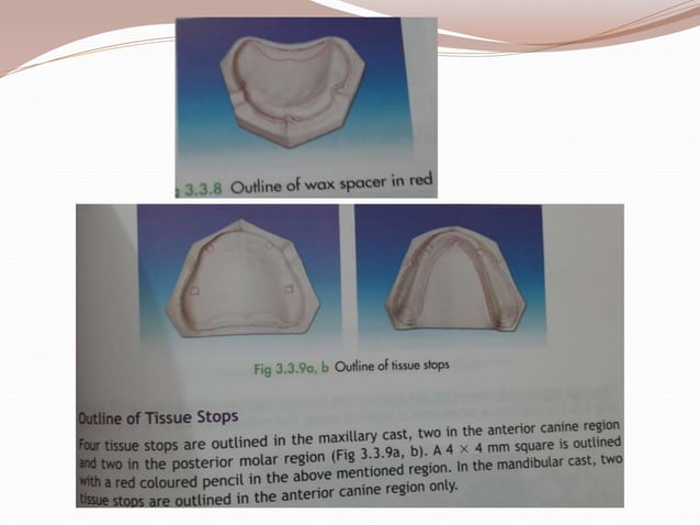 Secondary impression in complete denture CD | PPTX | Oral care ...