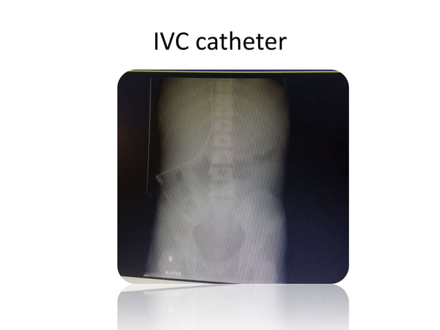 difficult vascular access | PPTX