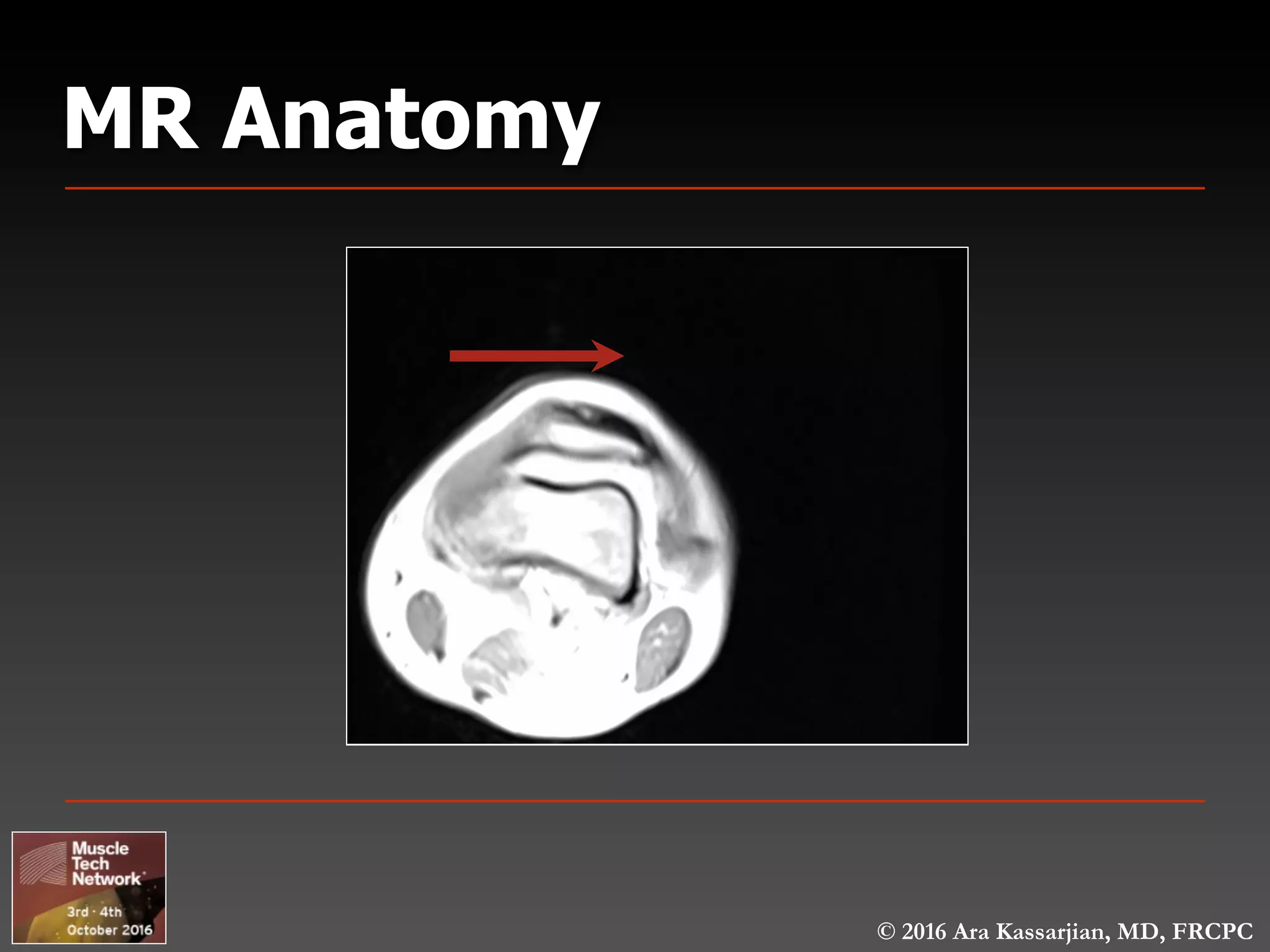Ara Kassarjian: MRI of the Rectus Femoris - PRP | PPTX