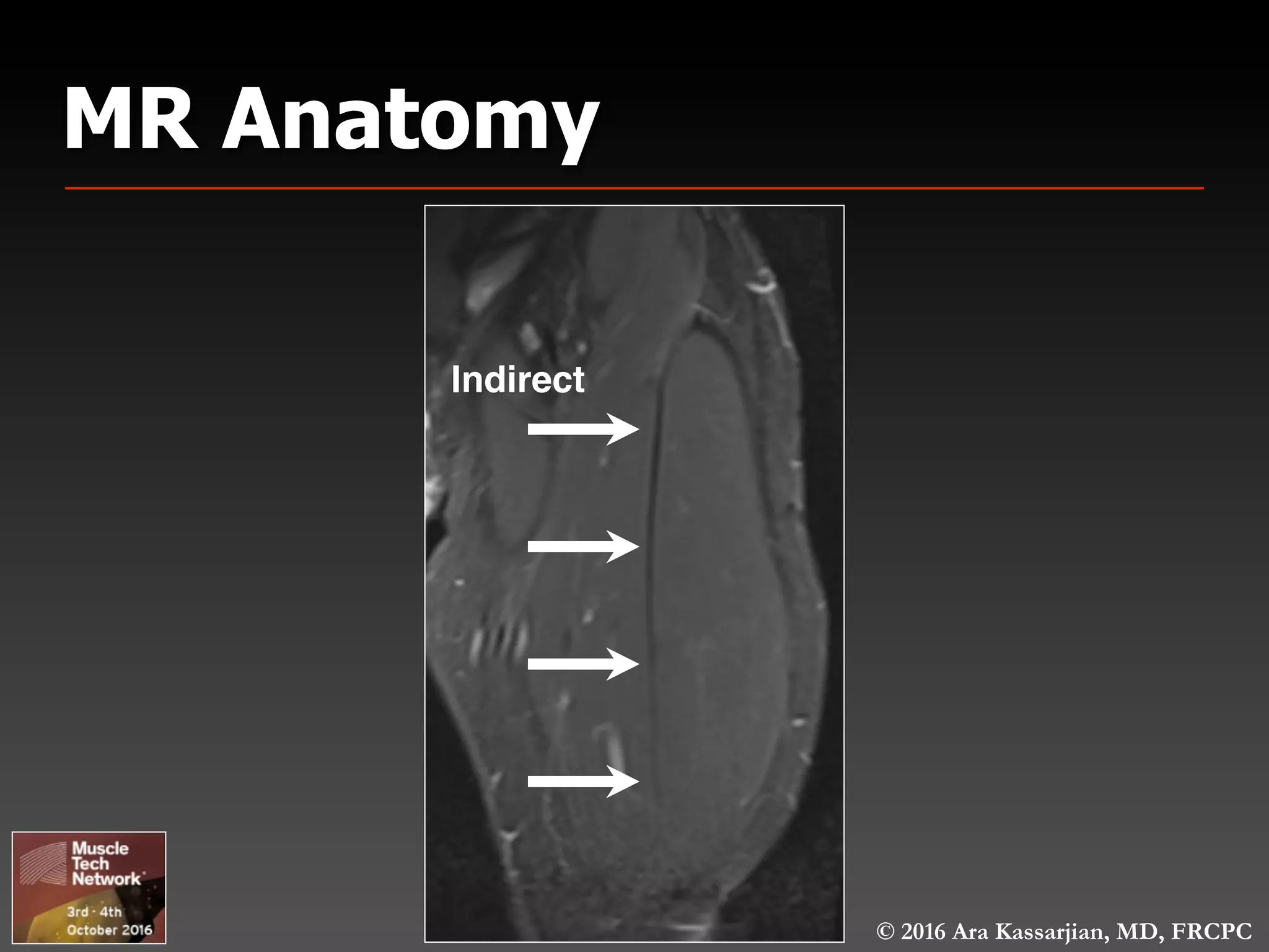 Ara Kassarjian: MRI of the Rectus Femoris - PRP | PPTX