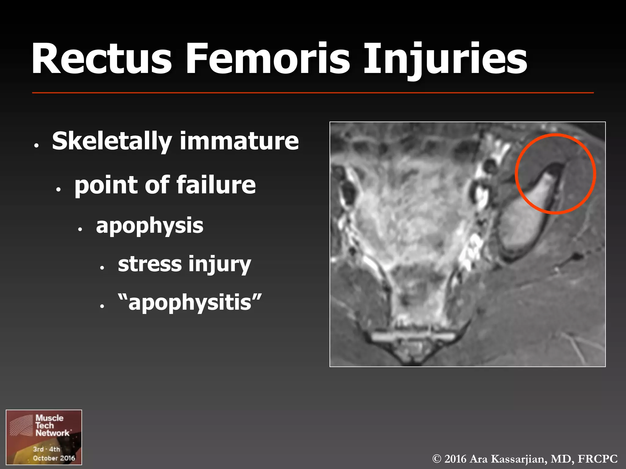 Ara Kassarjian: MRI of the Rectus Femoris - PRP | PPTX