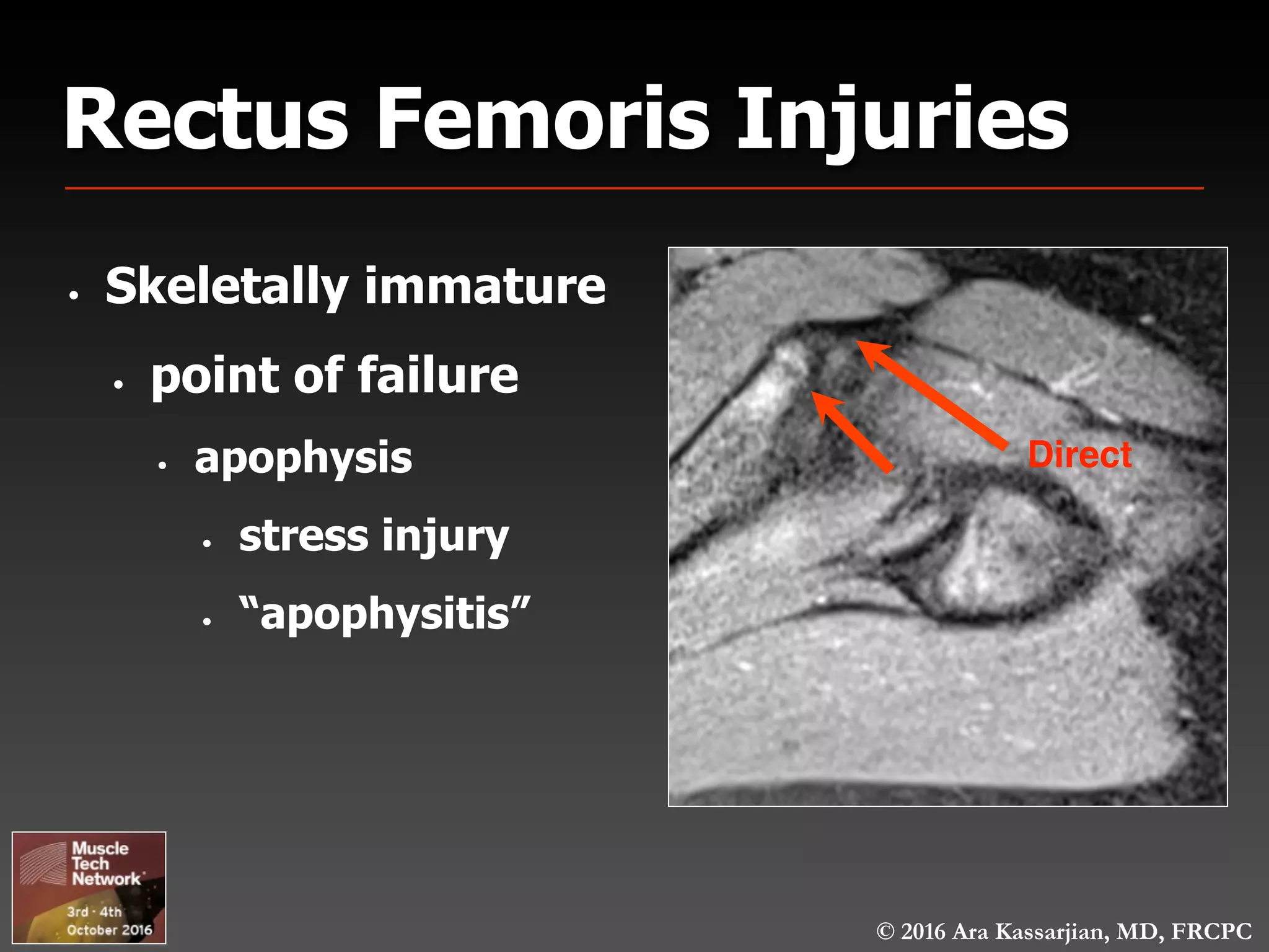 Ara Kassarjian: MRI of the Rectus Femoris - PRP | PPTX