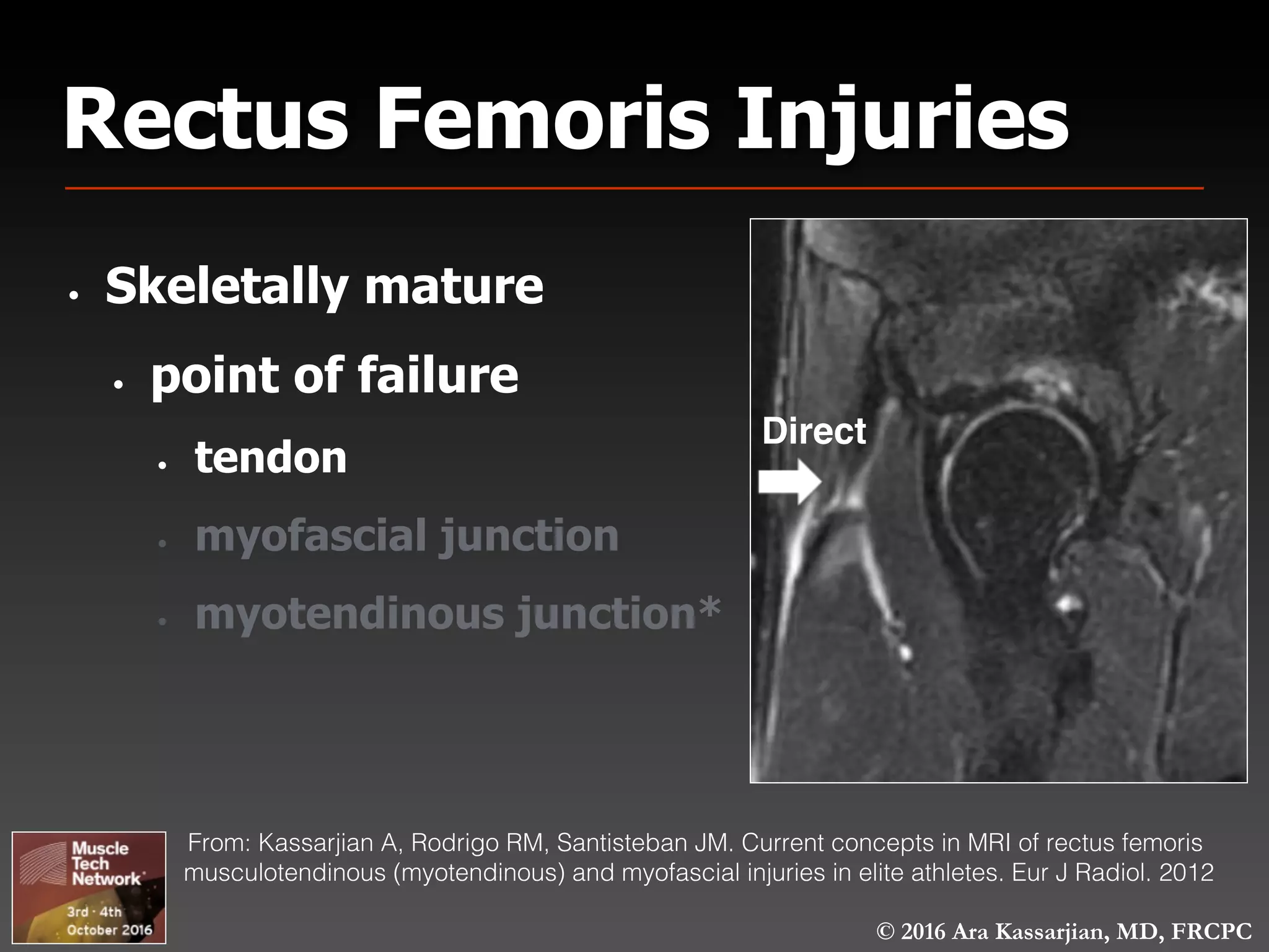 Ara Kassarjian: MRI of the Rectus Femoris - PRP | PPTX