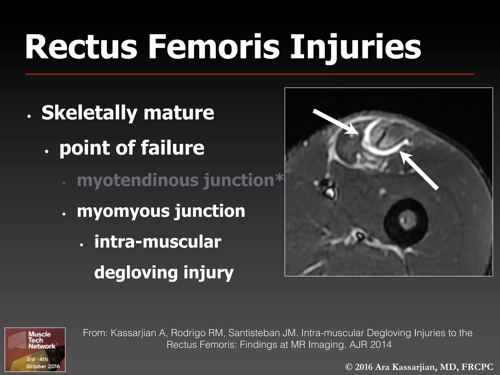 Ara Kassarjian: MRI of the Rectus Femoris - PRP | PPTX