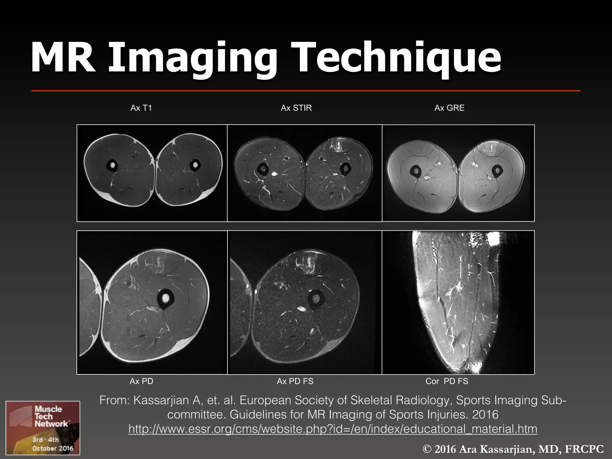 Ara Kassarjian: MRI of the Rectus Femoris - PRP | PPTX