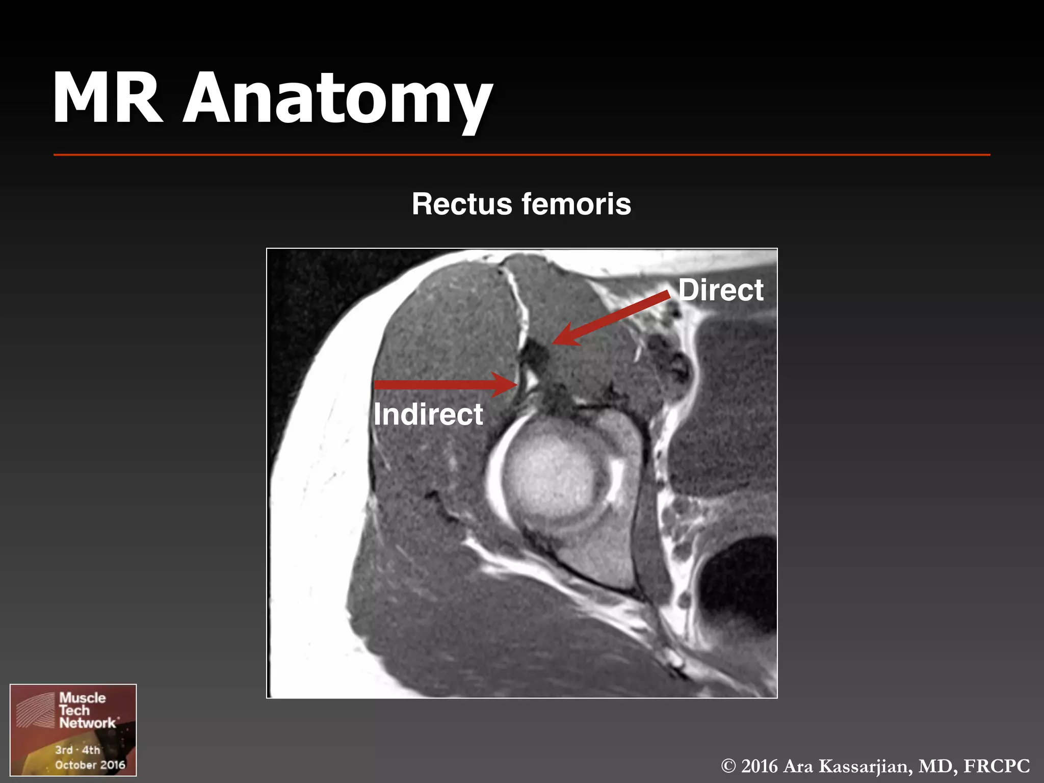 Ara Kassarjian: MRI of the Rectus Femoris - PRP | PPTX