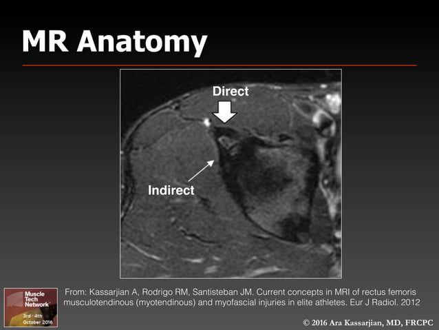 Ara Kassarjian: MRI of the Rectus Femoris - PRP | PPTX