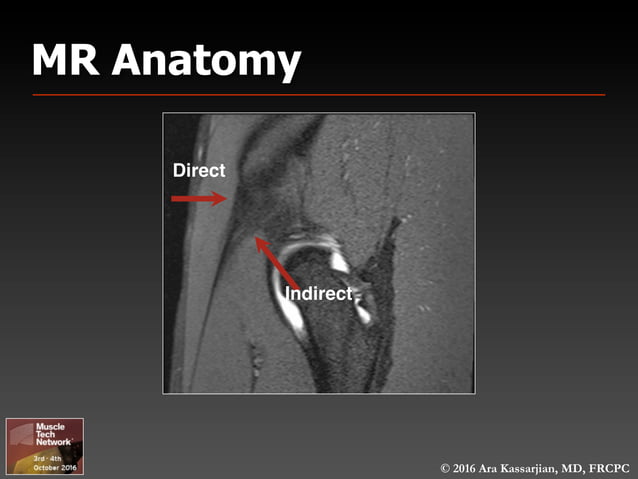 Ara Kassarjian: MRI of the Rectus Femoris - PRP | PPTX