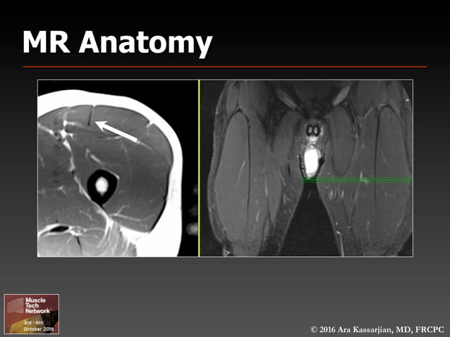 Ara Kassarjian: MRI of the Rectus Femoris - PRP | PPTX