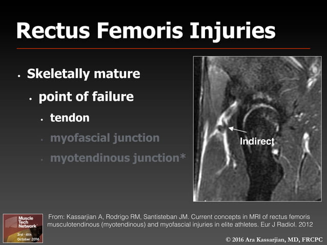 Ara Kassarjian: MRI of the Rectus Femoris - PRP | PPTX