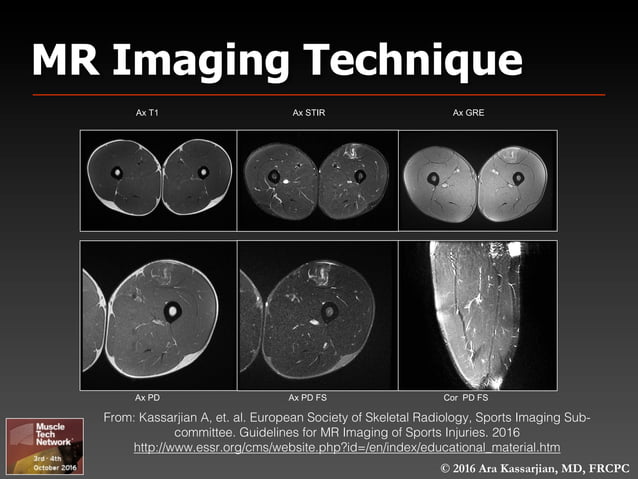 Ara Kassarjian: MRI of the Rectus Femoris - PRP | PPTX