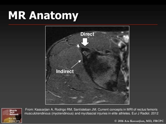 Mri Of Rectus Femoris Quadriceps Injury Radsource