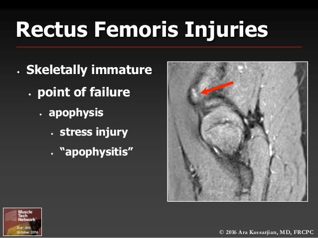 Ara Kassarjian: MRI of the Rectus Femoris - PRP