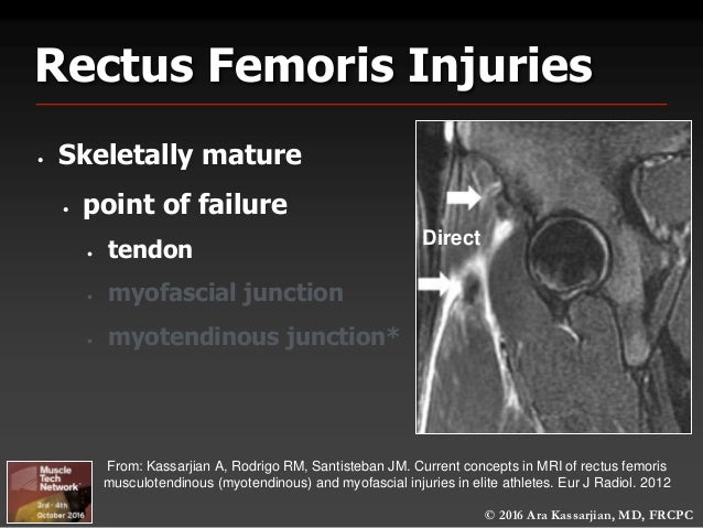 Ara Kassarjian: MRI of the Rectus Femoris - PRP