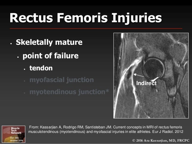 Ara Kassarjian: MRI of the Rectus Femoris - PRP