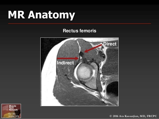 Ara Kassarjian: MRI of the Rectus Femoris - PRP
