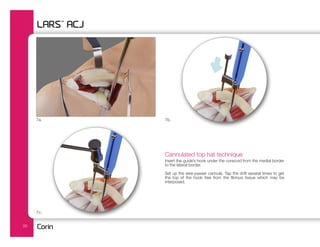 LARS ACJ Surgical Technique Corin Lennard Funk | PDF