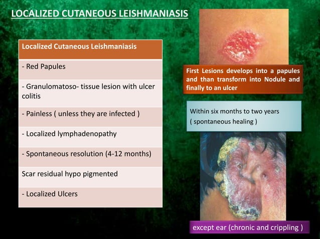 Leishmaniasis and Its Types and Cures | PPTX | Infectious Diseases ...