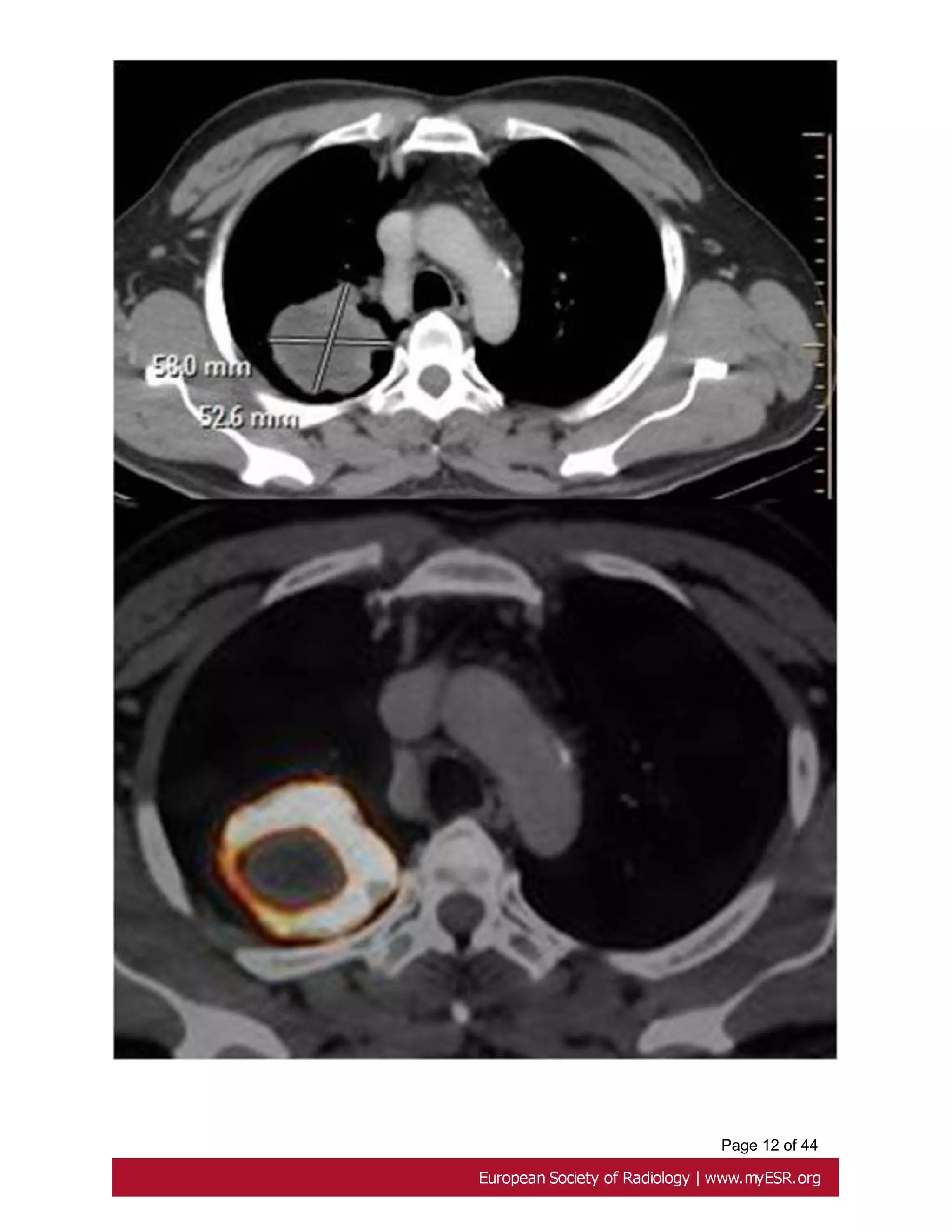 Restaging of Bronchogenic Carcinoma Based on 7th Edition of TNM Classification - Using ...
