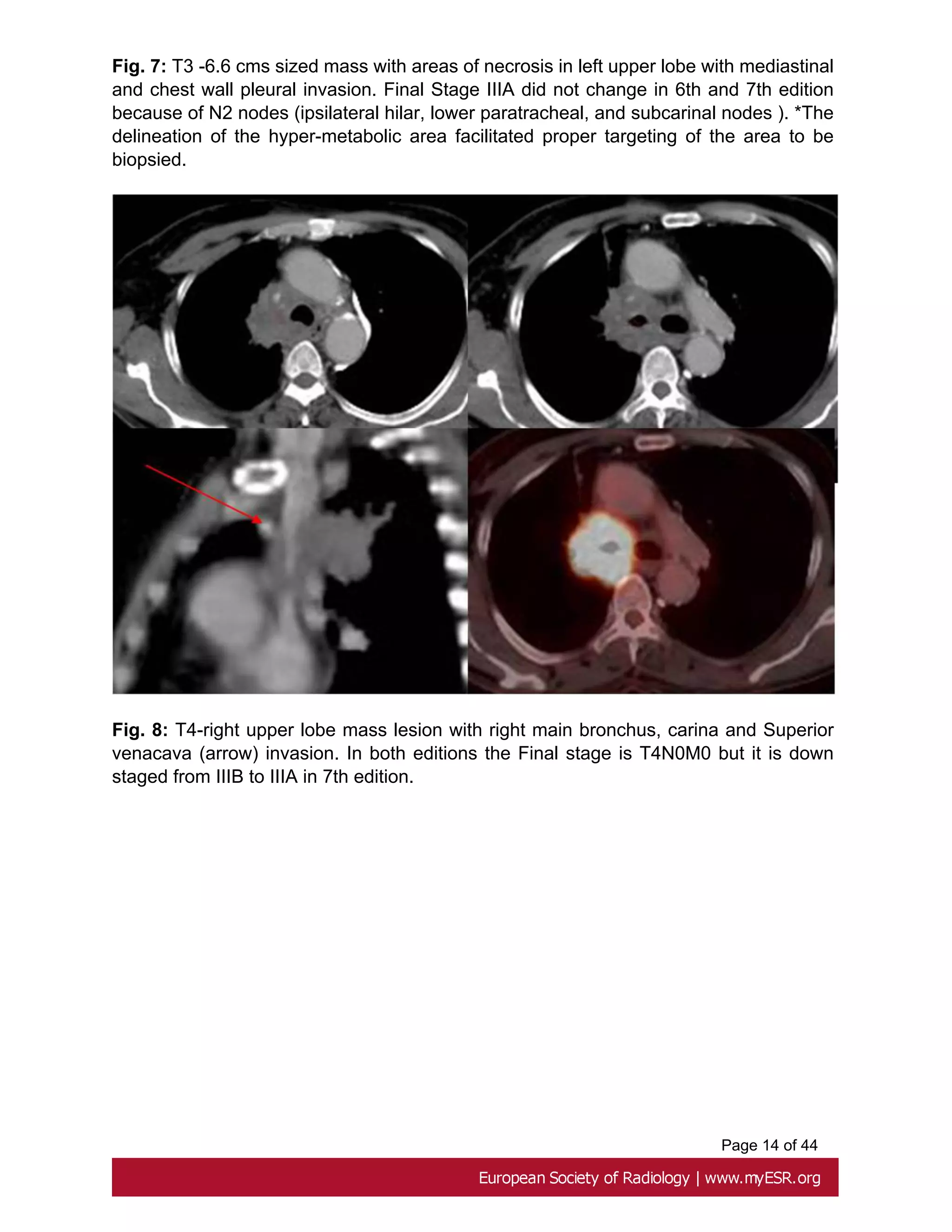 Restaging of Bronchogenic Carcinoma Based on 7th Edition of TNM Classification - Using ...
