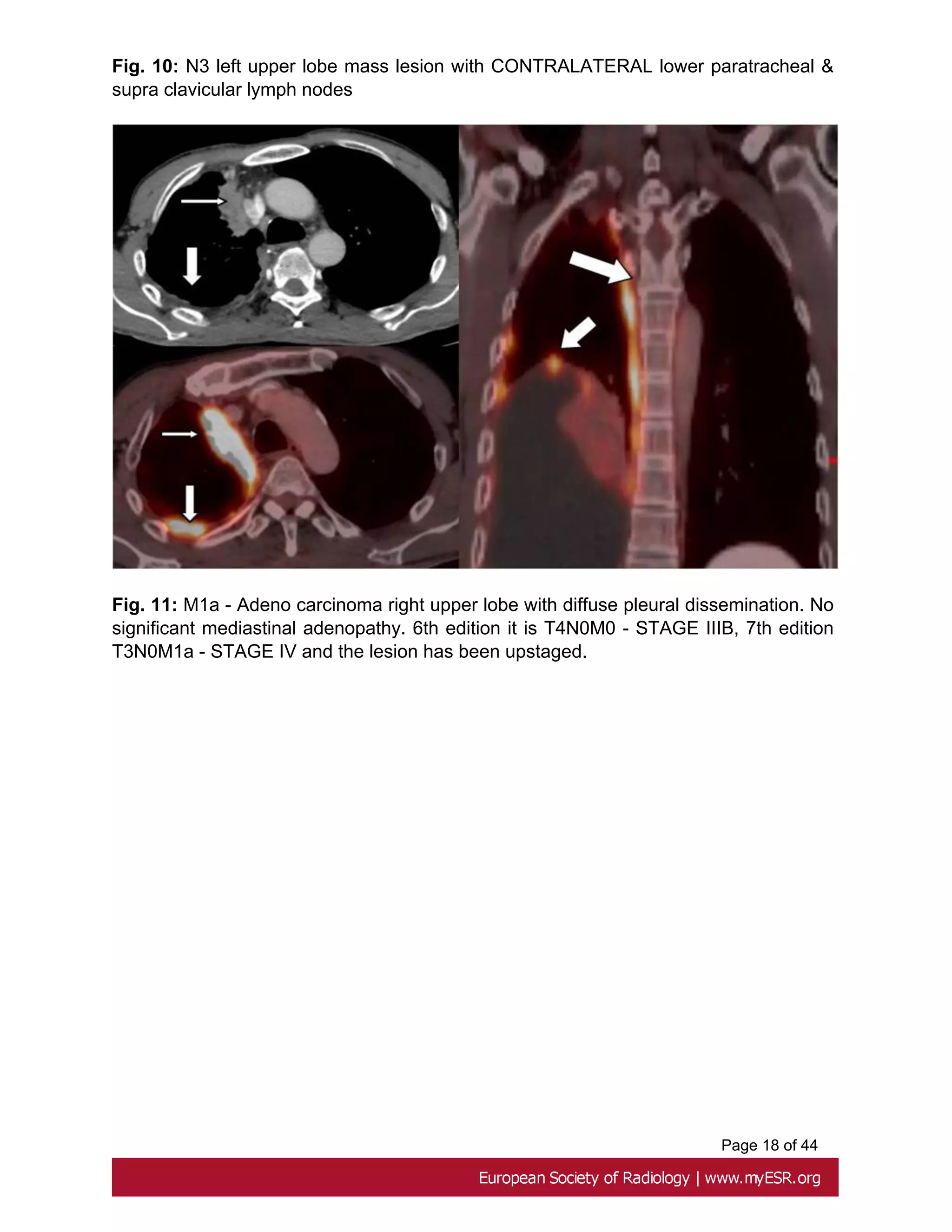 Restaging of Bronchogenic Carcinoma Based on 7th Edition of TNM Classification - Using ...
