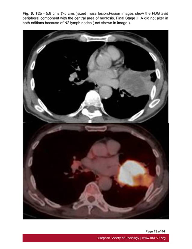 Restaging of Bronchogenic Carcinoma Based on 7th Edition of TNM Classification - Using ...
