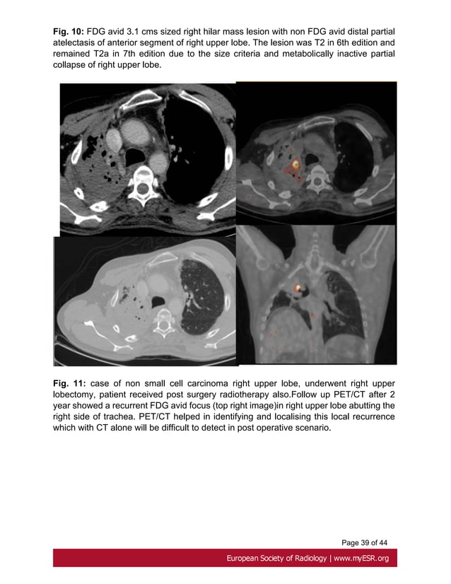 Restaging of Bronchogenic Carcinoma Based on 7th Edition of TNM Classification - Using ...