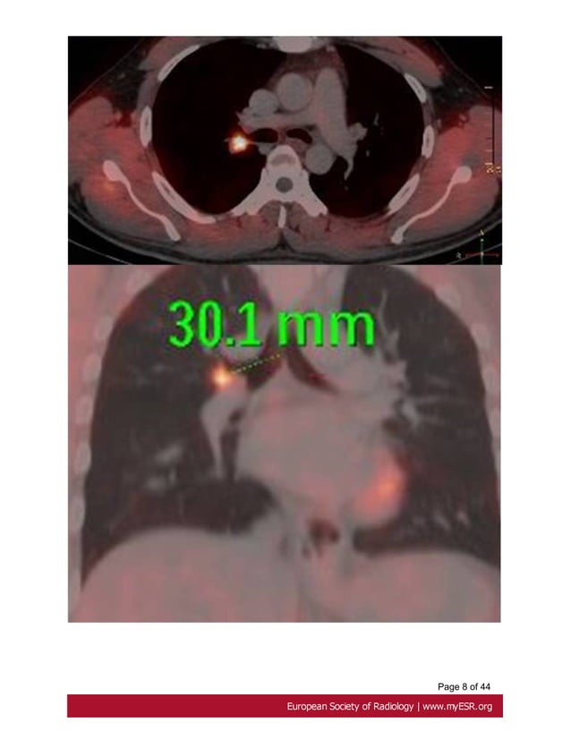 Restaging of Bronchogenic Carcinoma Based on 7th Edition of TNM Classification - Using ...
