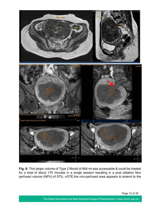 Problems & Solutions in Fibroid Ablation with MRGHIFUS | PDF ...