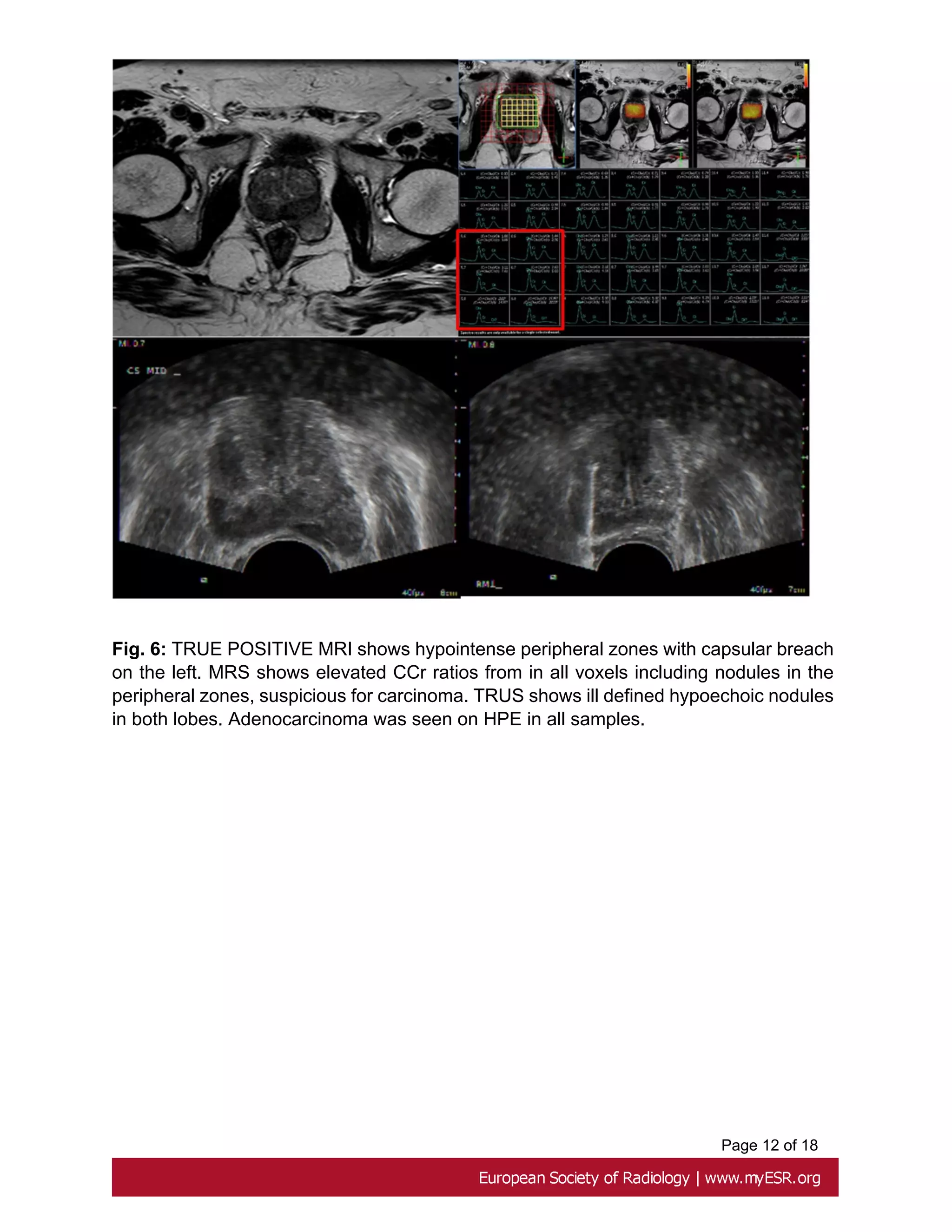 Mri Guided Trans Rectal Ultrasound Biopsy A Molecular Approach To