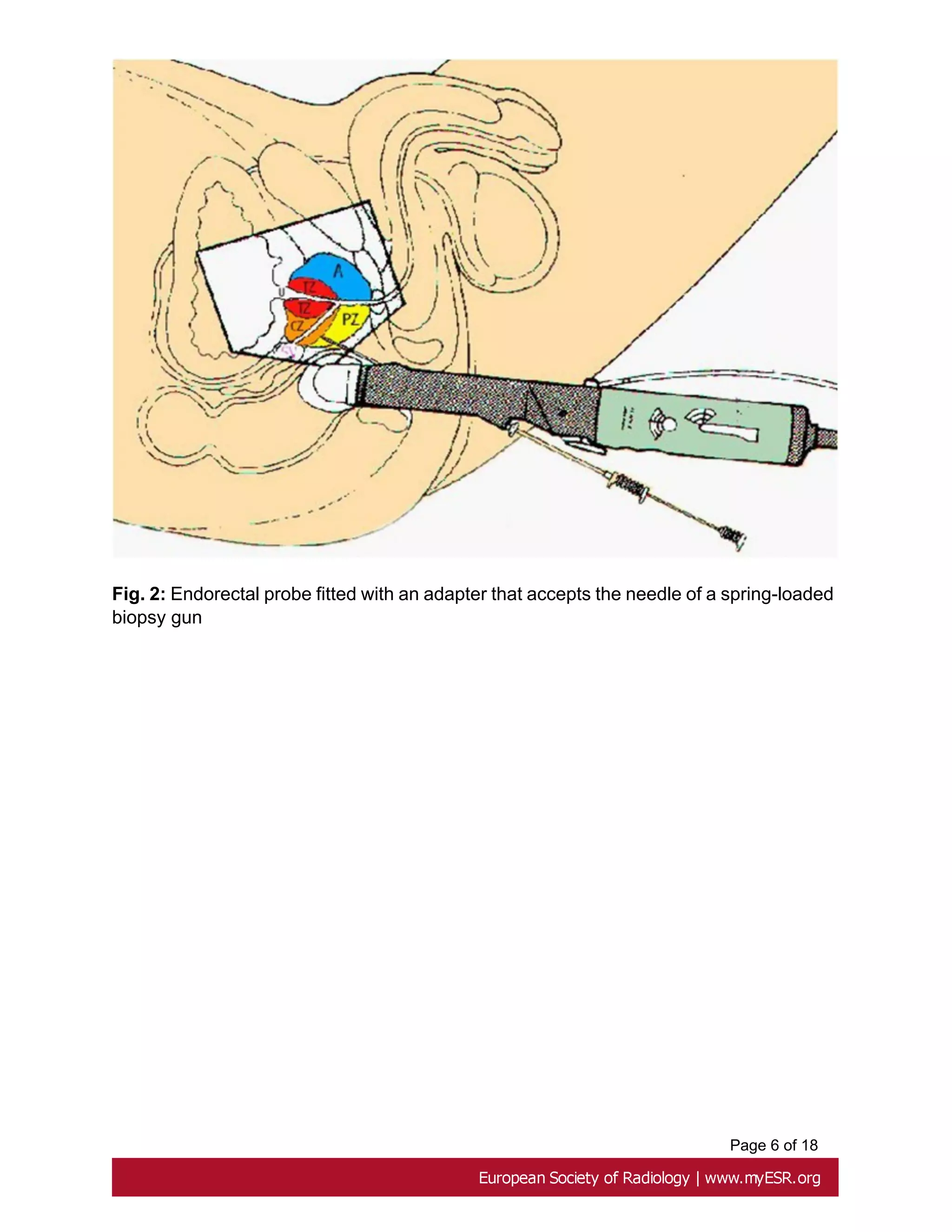 MRI Guided Trans Rectal Ultrasound Biopsy: A Molecular Approach to ...