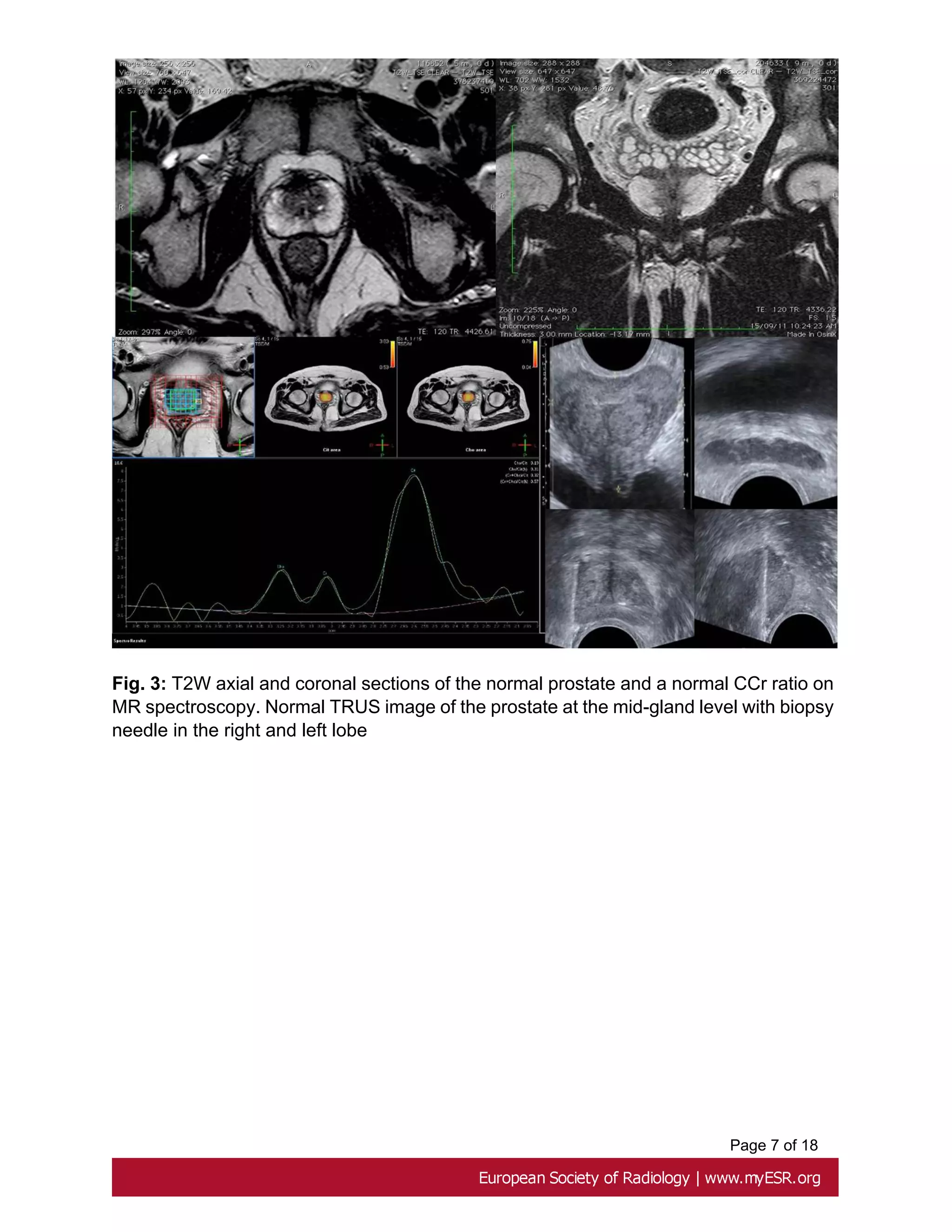 MRI Guided Trans Rectal Ultrasound Biopsy: A Molecular Approach to ...