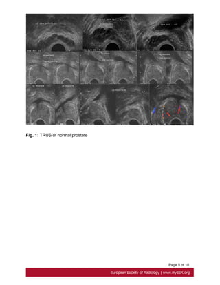 MRI Guided Trans Rectal Ultrasound Biopsy: A Molecular Approach to ...
